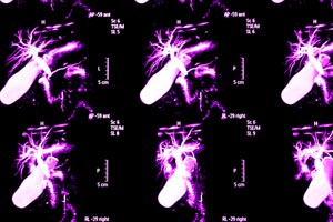 Magnetic resonance cholangiopancreatography (MRCP) - myDr.com.au