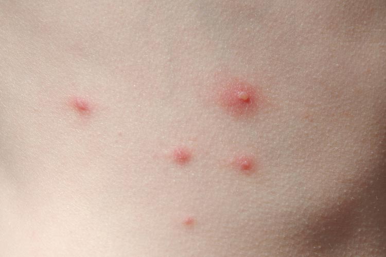 Childhood Rashes MyDr au