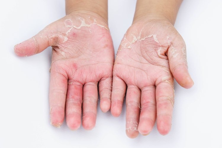 Dermatitis Hands