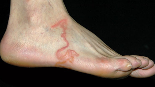 Squirming worm infection in foot - myDr.com.au