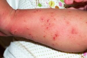 Scabies - MyDr.com.au
