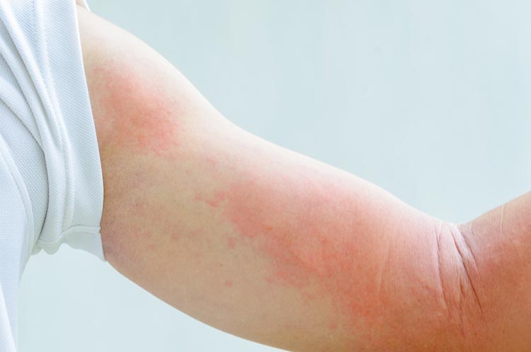 Urticaria (hives) - myDr.com.au