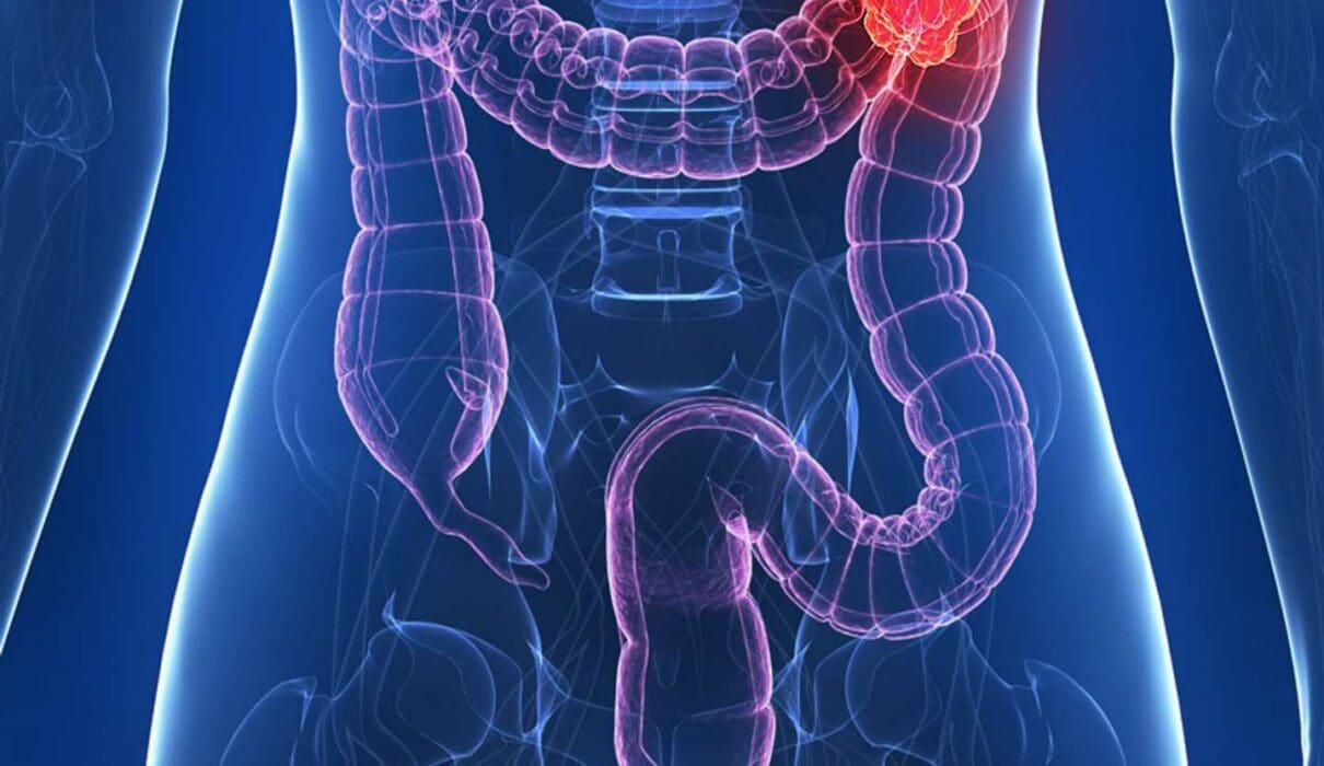 Bowel Cancer Awareness Month - MyDr.com.au