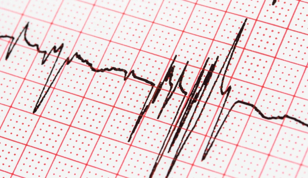 How is atrial fibrillation treated? Dr David Celermajer - MyDr.com.au