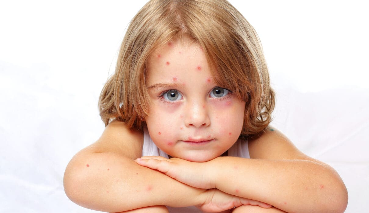 Does Smallpox Still Exist and What is It? Dr. Norman Swan - MyDr.com.au
