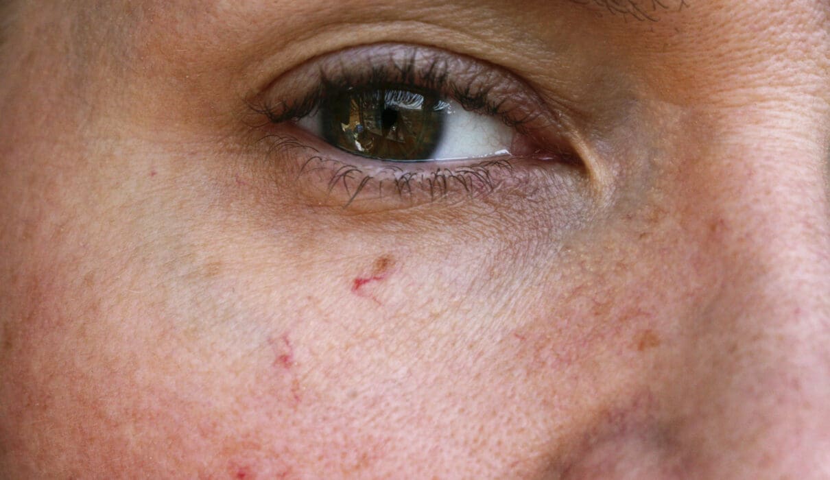 What is Hereditary Haemorrhagic Telangiectasia? - MyDr.com.au