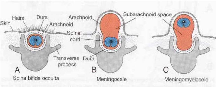 Spina Bifida Occulta Dimple